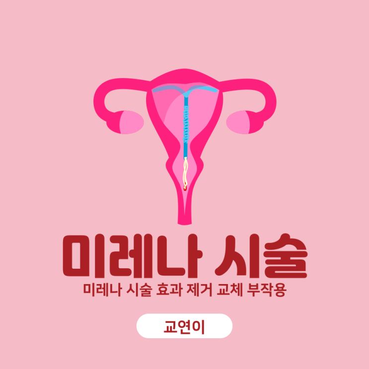 미레나 시술 효과 제거 교체 여성 피임 방법 부작용 체중증가 네이버 블로그