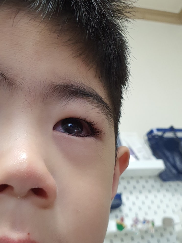 플릭텐(phlycten) 각결막염 증상, 치료약, 치료경과 : 네이버 블로그