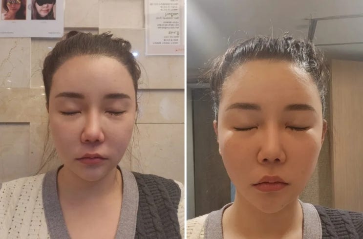 압구정피부과 얼굴실리프팅 잘하는곳에서 붓기없는효과후기 내돈내산 네이버 블로그