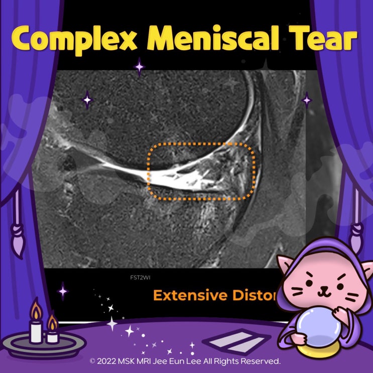 (Fig 1-B.19) Complex meniscal tear : 네이버 블로그