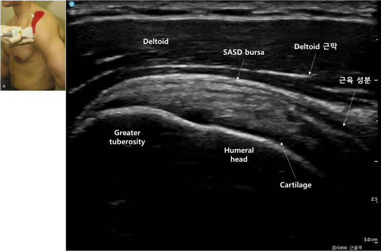 [어깨 초음파] 3. 극상근 건 (Supraspinatus tendon) : 네이버 블로그