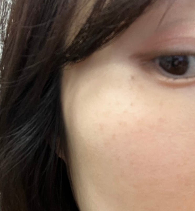 강남역 피부과흑자제거 레이저 당일~한달 찐후기 비용 관리 비포애프터사진 있음 네이버 블로그