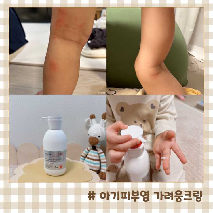 아기피부염 오돌토돌 발진 긁는아기 건조 가려움 크림 일리윤 네이버 블로그