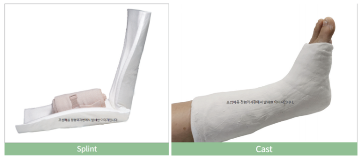 [OS 공부] 보조기/Splint/Cast/Crutch/Walker : 네이버 블로그