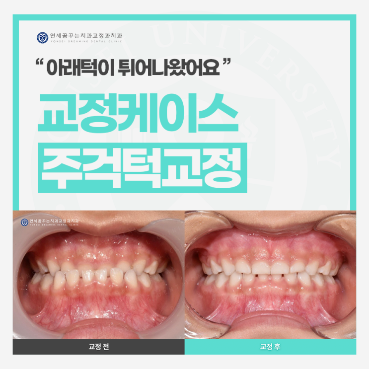 평택치과 6세 어린이 주걱턱 교정 아래턱이 튀어나왔어요 네이버 블로그