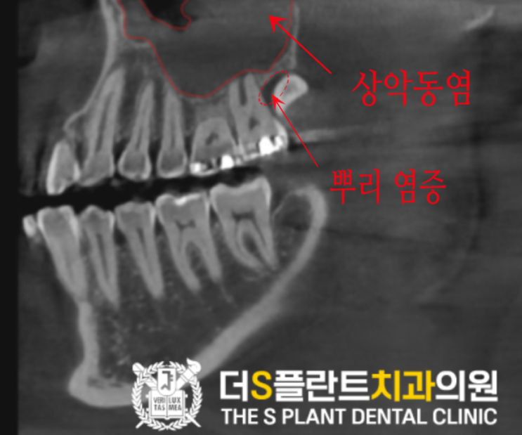 수원 인계동 치과 수면사랑니발치 의식하진정법 수술로 상악동염 치료 네이버 블로그