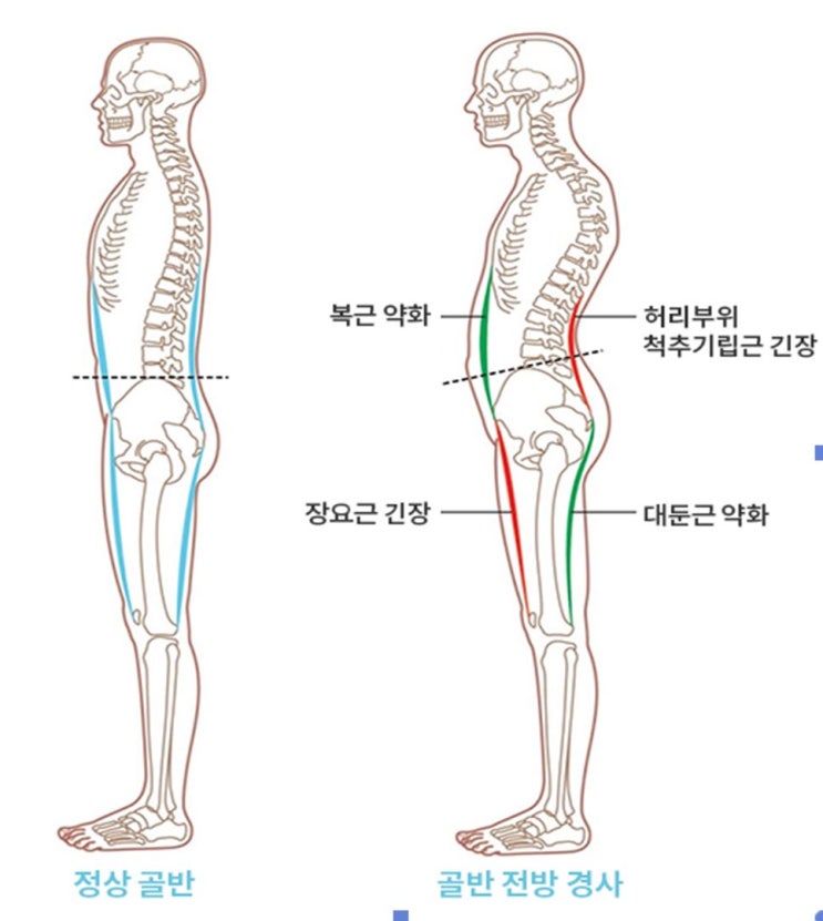 만수동 필라테스 만수6동 필라테스 만수동 기구필라테스 허리통증으로 이어지는 골반 전방경사 원인 및 교정 방법