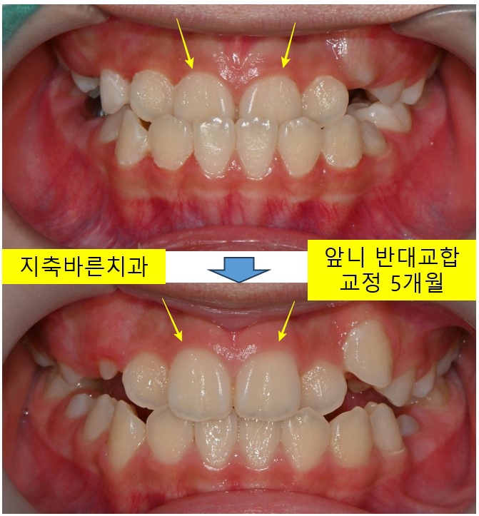 앞니 반대교합 페이스마스크 교정성장판검사 지축치과 지축역치과 지축교정 유학생치과 삼송교정 삼송치과 원흥치과원당치과화정치과금촌