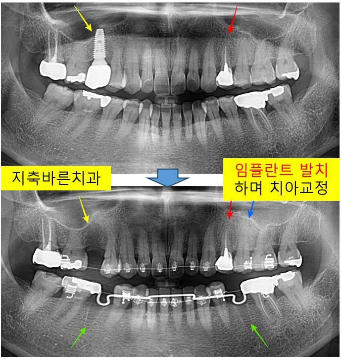 타치과 임플란트 발치하며 교정 지축치과 지축역치과 지축교정 유학생치과 삼송교정 삼송치과 원흥치과원당치과화정치과금촌치과능곡치과