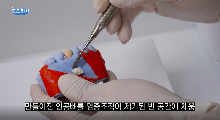 치아를 살리는 치근단절제술 치료과정 네이버 블로그