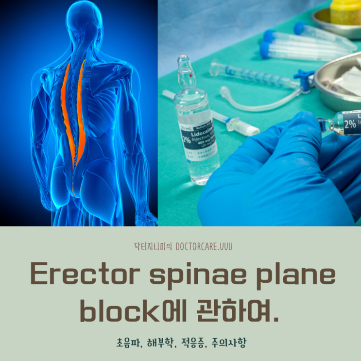 Erector spinae plane block (ESP block) 척추기립면 신경 차단술에 관하여. : 네이버 블로그