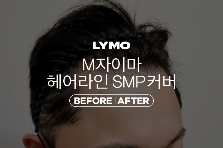 LYMO 시술일지 [Before/After] 쁘띠시술. 남자M자이마 / 들쑥날쑥한 헤어라인은 라이모에서 해결하세요 : 네이버 블로그