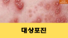 대상포진이란 진료는 피부과 초기증상얼굴 손가락 전염성 알아보기 네이버 블로그
