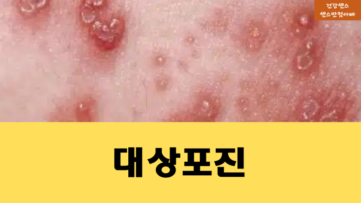 대상포진이란 진료는 피부과 초기증상얼굴 손가락 전염성 알아보기 네이버 블로그