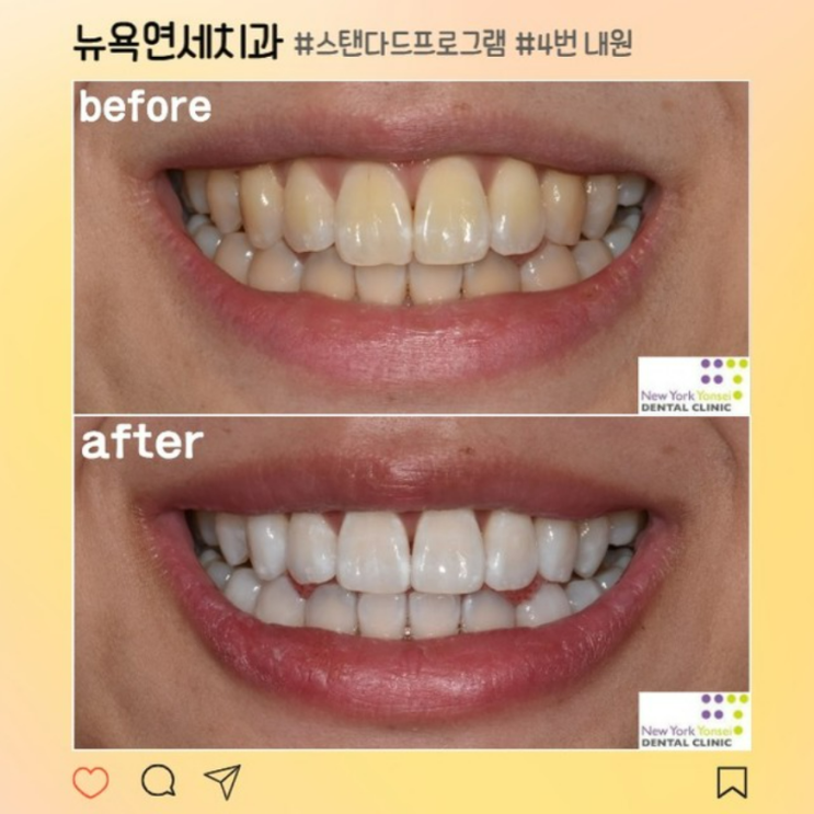 강남역치아미백 확실한 효과를 원한다면 : 네이버 블로그