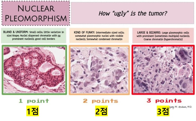 유방암 조직학적 등급 histologic grade, 핵등급 nuclear grade 이란? : 네이버 블로그