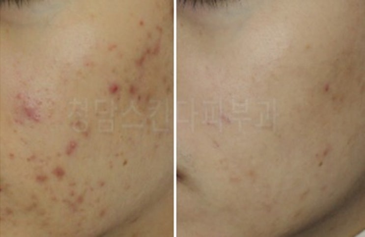 여드름 붉은자국 레이저 종류 및 효과 네이버 블로그