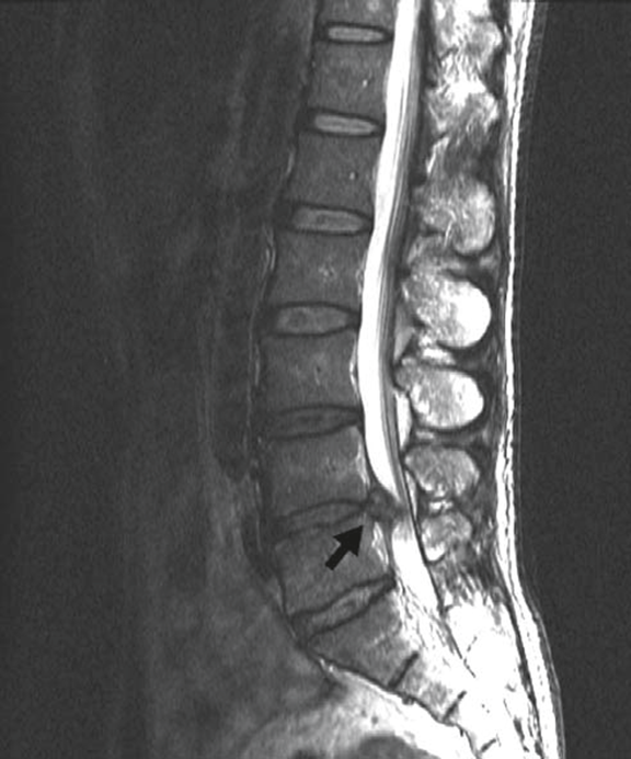 Spontaneous regression of lumbar herniated disc, 케이스 : 네이버 블로그