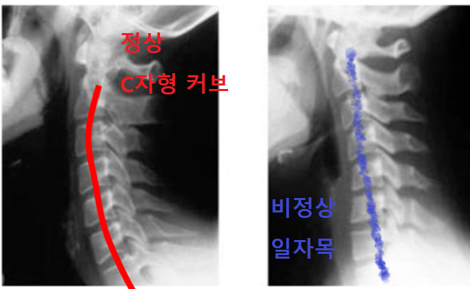 거북목, 일자목, 거북목 증후군(Turtle neck syndrome) : 네이버 블로그