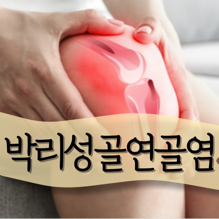 박리성골연골염 군대 면제 질환인지 알아봐요 네이버 블로그