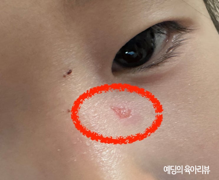 아기 손톱 패인 상처 듀오덤 및 피부과 방문 손톱자국 흉터 치료과정 네이버 블로그