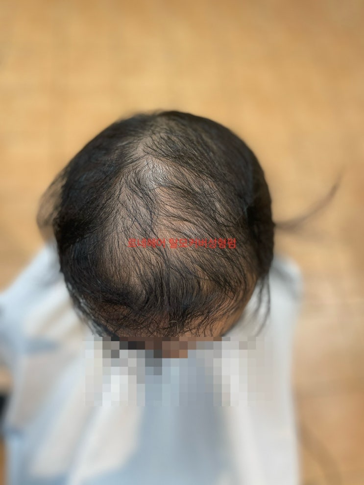 남자 탈모 일타 탈모 펌 부산사상르네시떼6층미용실감전주례학장하단다대명지용원녹산대저화명연제전포거제리동래명륜범일금정김해양산울산