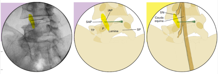 Lumbar facet joint block, Medial branch block : 네이버 블로그