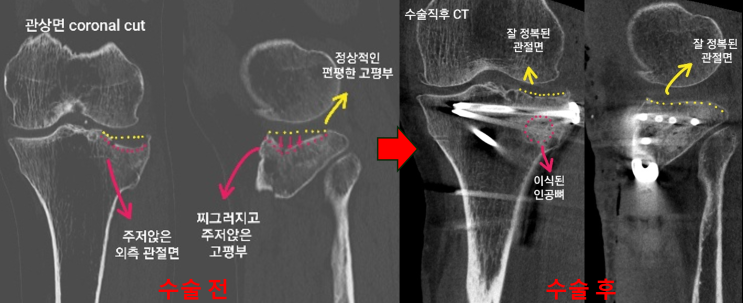 경골 고평부 골절 Tibia Plateau Fracture 가장 난이도 있는 무릎 골절 수술의 재활 방법과 보행 영상 소개