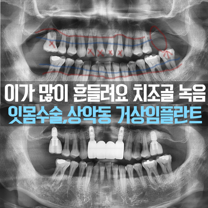 대구임플란트치과 E28치과 이가 많이 흔들려요 치조골 녹음 잇몸치료상악동 거상술 내비게이션 임플란트 네이버 블로그