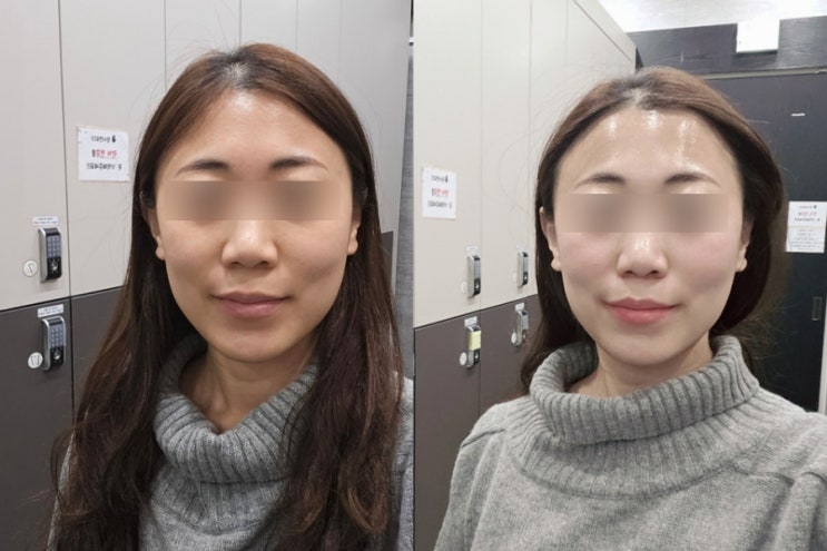 안산피부과 온다리프팅ldm 물방울 리프팅 후기 웨딩 피부관리 추천 네이버 블로그