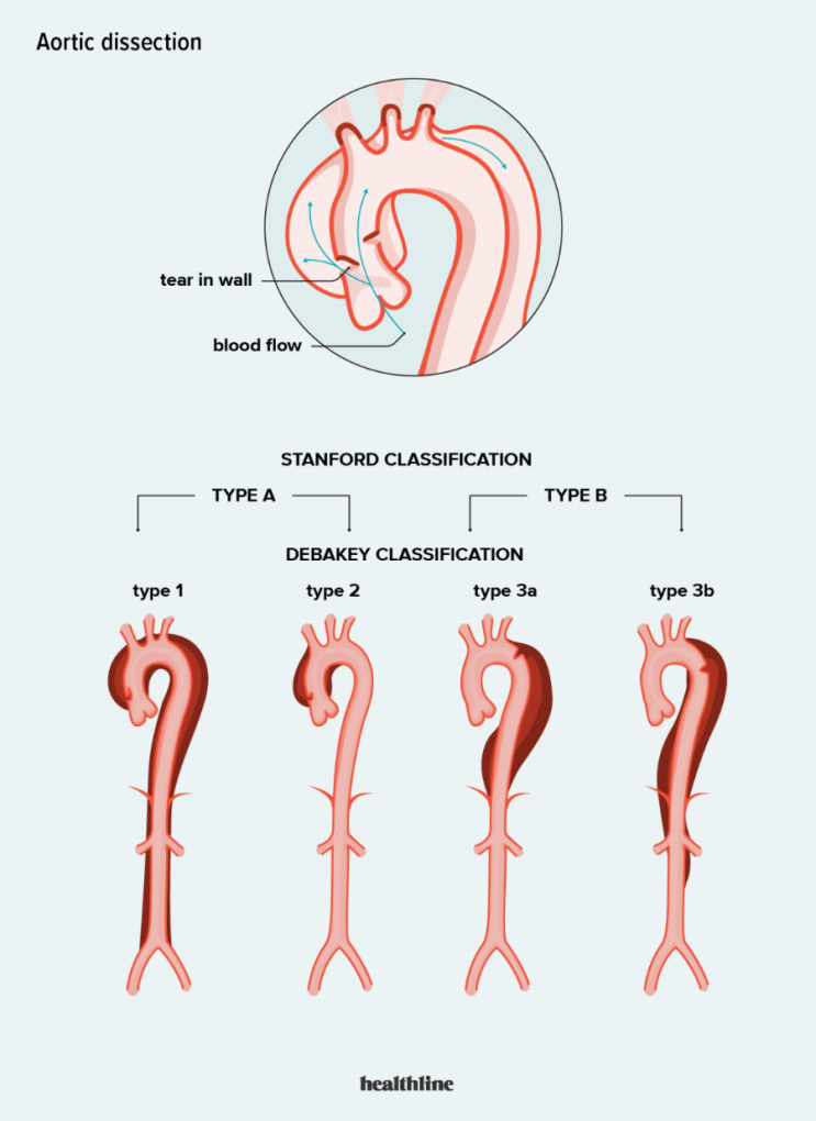Aortic dissection 대동맥박리란? 대동맥박리 간호 : 네이버 블로그