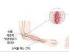 테니스엘보우주관절 외상과염 증상 및 치료 수술 방법팔꿈치 바깥쪽 통증 힘줄 파열 신전근 스트레칭 네이버 블로그