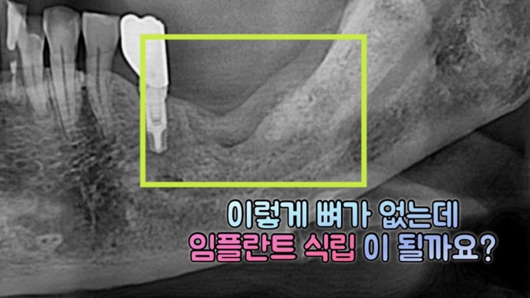 소사벌 치과 치조골 이식수술 임플란트 뼈이식의 과정 및 이유 뼈이식후기 네이버 블로그