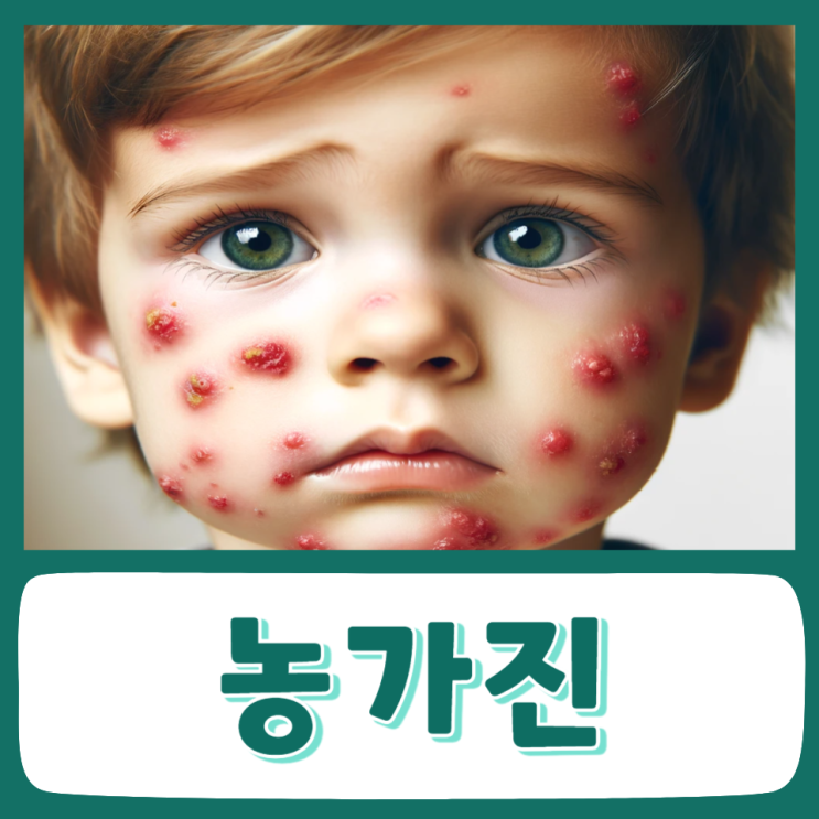 농가진 격리 기간 원인 증상 치료법 네이버 블로그