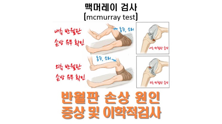 무릎 반월판 손상(tear of meniscus) 원인, 증상 및 맥머레이 검사(mcmurray test) : 네이버 블로그