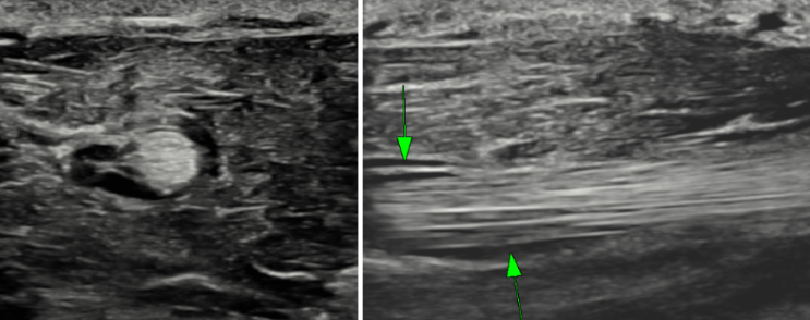 [수부] 손의 감염 : 감염성 건막염 Kanavel's Sign (Infectious pyogenic flexor ...
