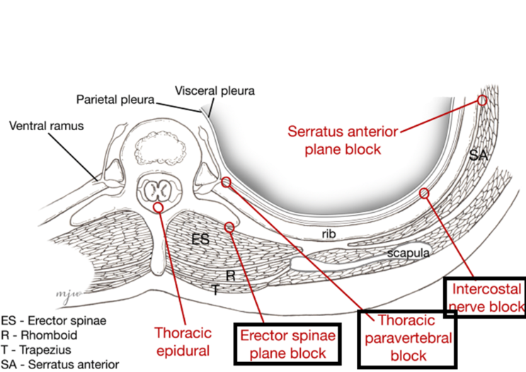 ESPB (Erector spinae plane block) vs TPVB (Thoracic paravertebral block ...