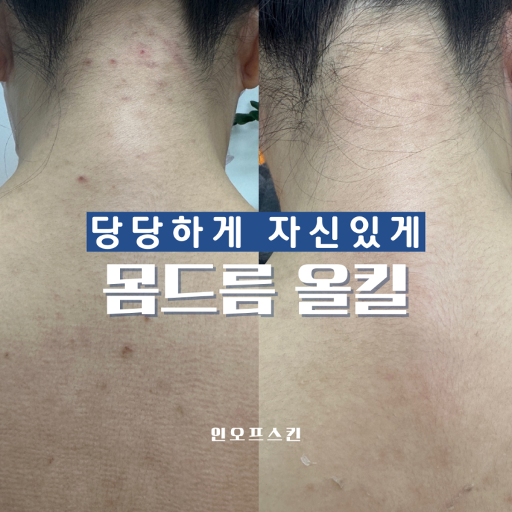 진주 피부관리 등드름 가드름 관리 잘 하는 곳 네이버 블로그