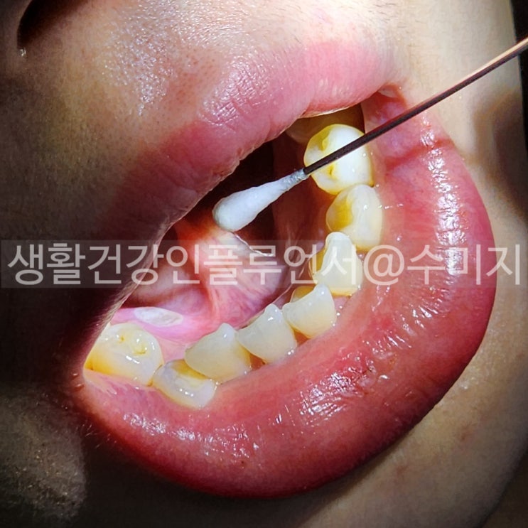 입안 혓바닥 혀 염증 혓바늘 원인 약 없애는법 혓바늘 알보칠 네이버 블로그