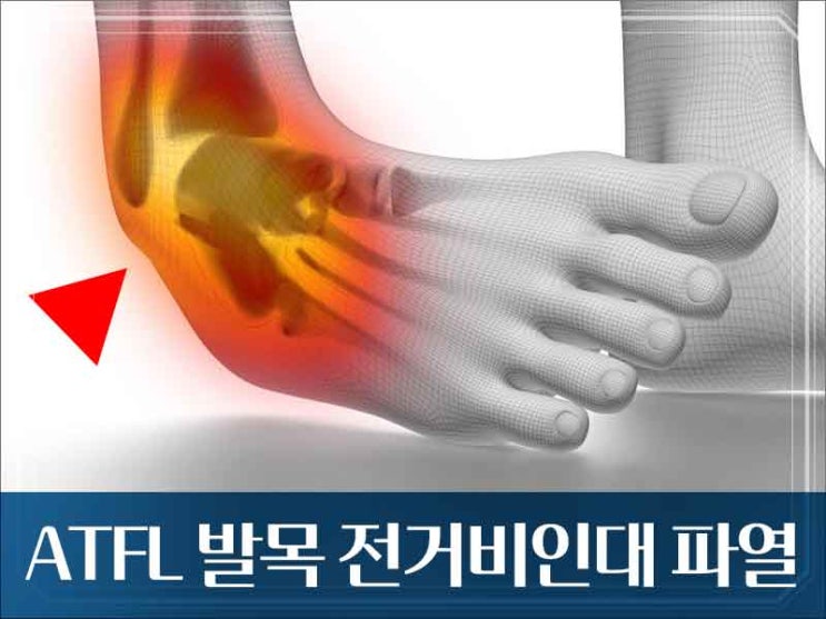 ATFL 발목 전거비인대 파열, 예외적으로 수술이 필요한 경우 : 네이버 블로그
