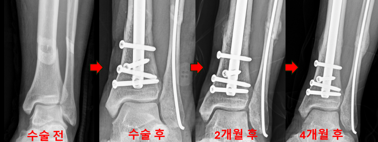 40대 환자의 정강이뼈 골절 Distal Tibiofibular Shaft Fracture 원위 경비골골절 수술 후 언제쯤