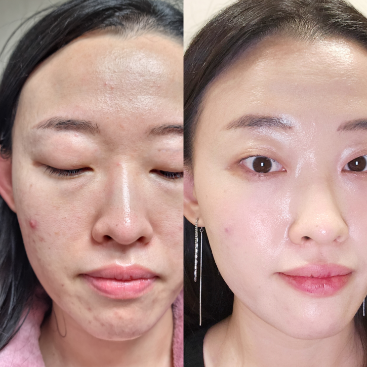 티타늄리프팅 턱선리프팅 제대로 된 내돈내산 찐 후기가격 부작용 효과 통증 네이버 블로그