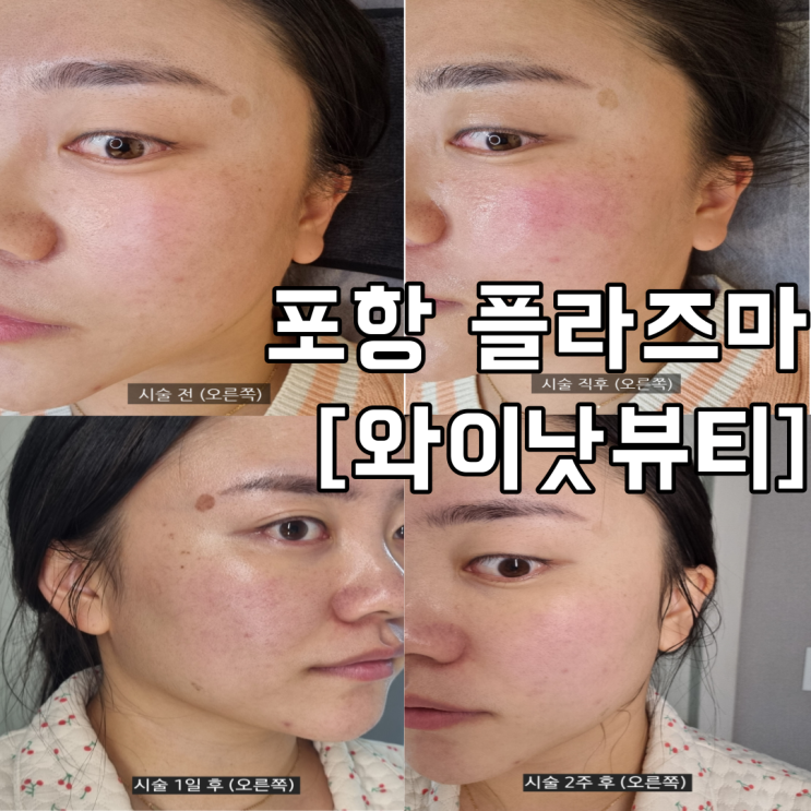 포항 플라즈마 와이낫뷰티 여드름관리 기미제거 관리 후기 네이버 블로그