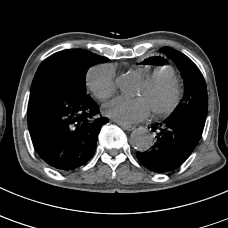 Perm cath.를 self removal 하려던 환자의 chest CT - "뭐가 보이나요?" : 네이버 블로그