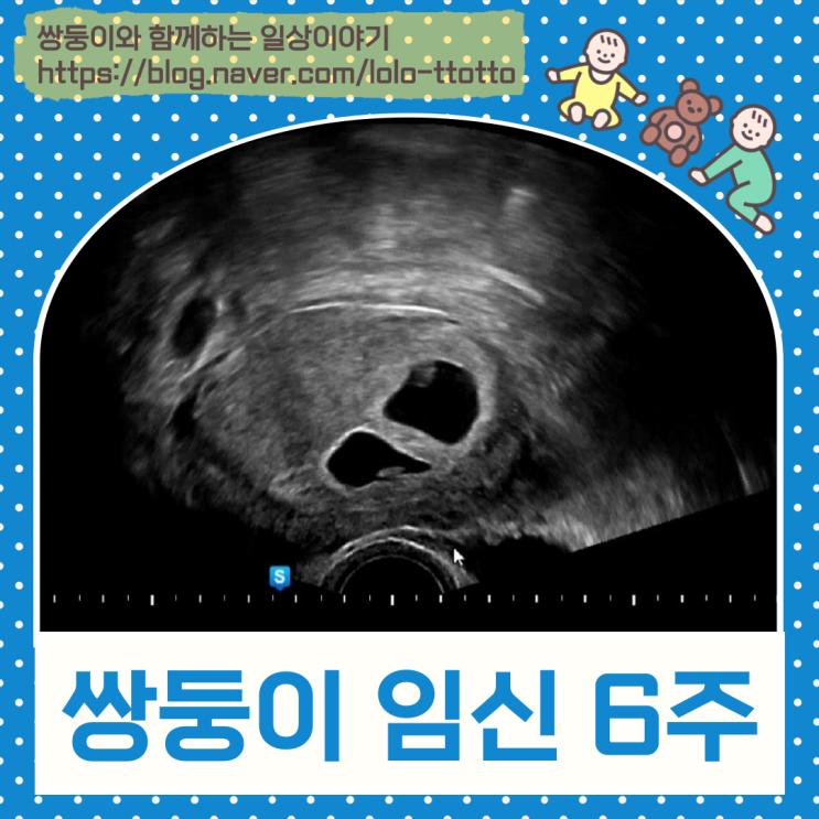 쌍둥이 임신 일기 임신 초기 6주 초음파 난황 임신 축하 선물더마비 버츠비 아토팜 튼살크림 레깅스 영양제