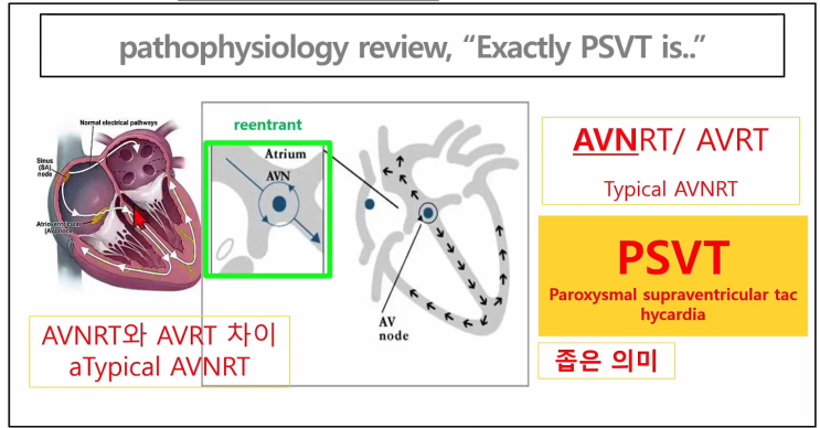 [임상 동영상 강의 추천] 발작성 상심실성 빈맥(PSVT)의 진단과 치료 [Paroxysmal Supraventricular ...