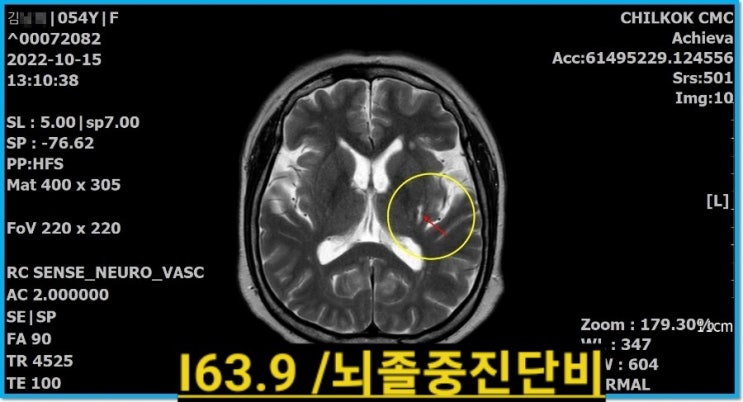 I63.9 뇌경색증으로 뇌졸중진단비 쉽게 받은 사례 : 네이버 블로그