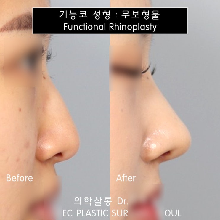 비염 수술 및 무보형물 코성형 기능코 수술 【dr 아베크 코성형】 네이버 블로그