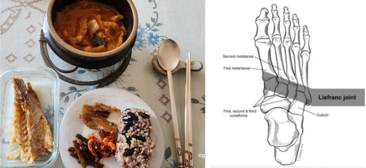 반깁스 2일차 : 남편이 차려준 밥상을 받다, 발뼈골절 리스프랑골절(Lisfranc Fleck sign) : 네이버 블로그