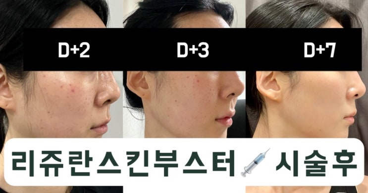 리쥬란 힐러 스킨부스터 시술 후기 트러블 엠보 통증 효과 기간 가격 네이버 블로그